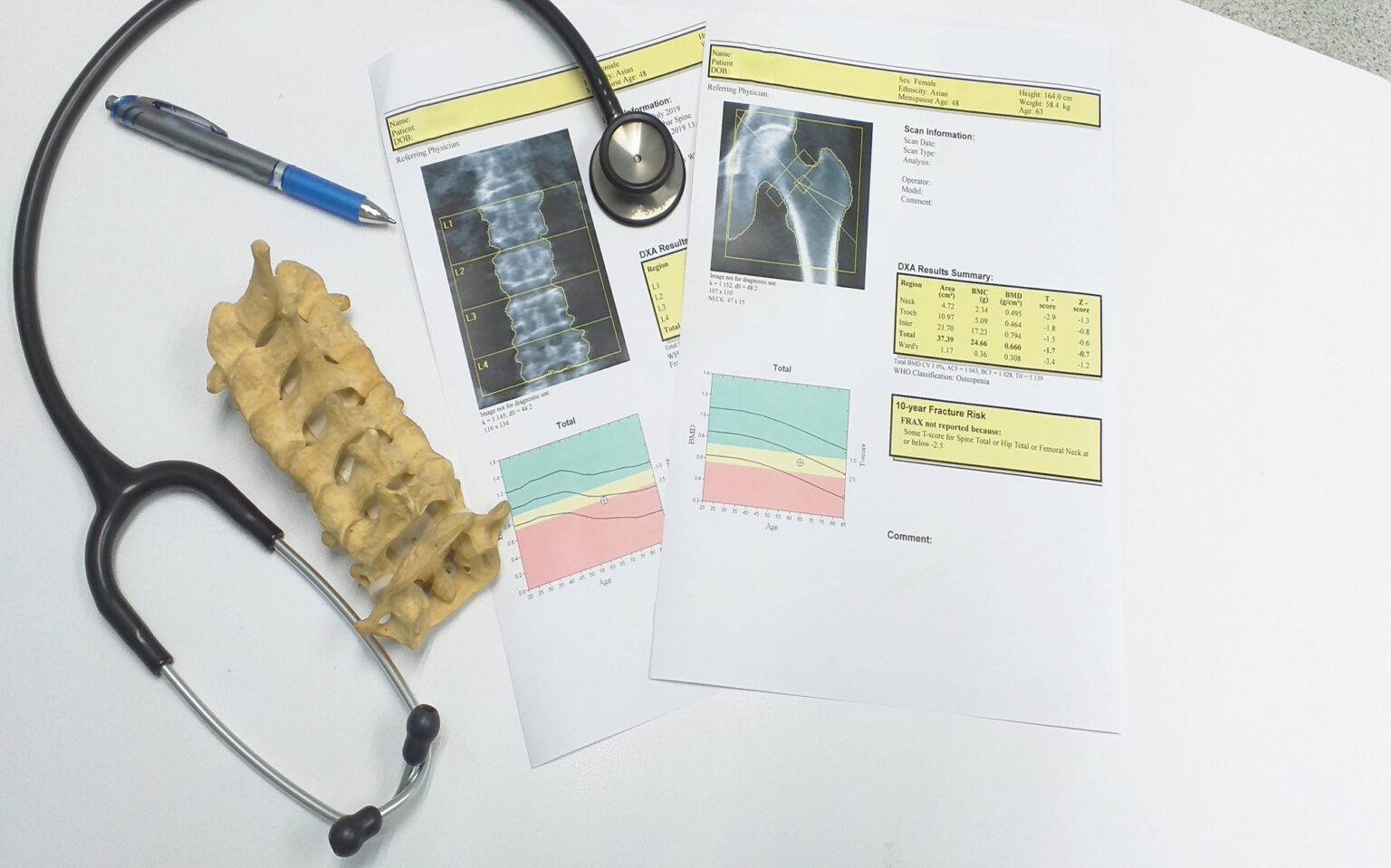 Mitä tarkoittavat osteoporoosi ja osteopenia sekä mistä ne johtuvat ...